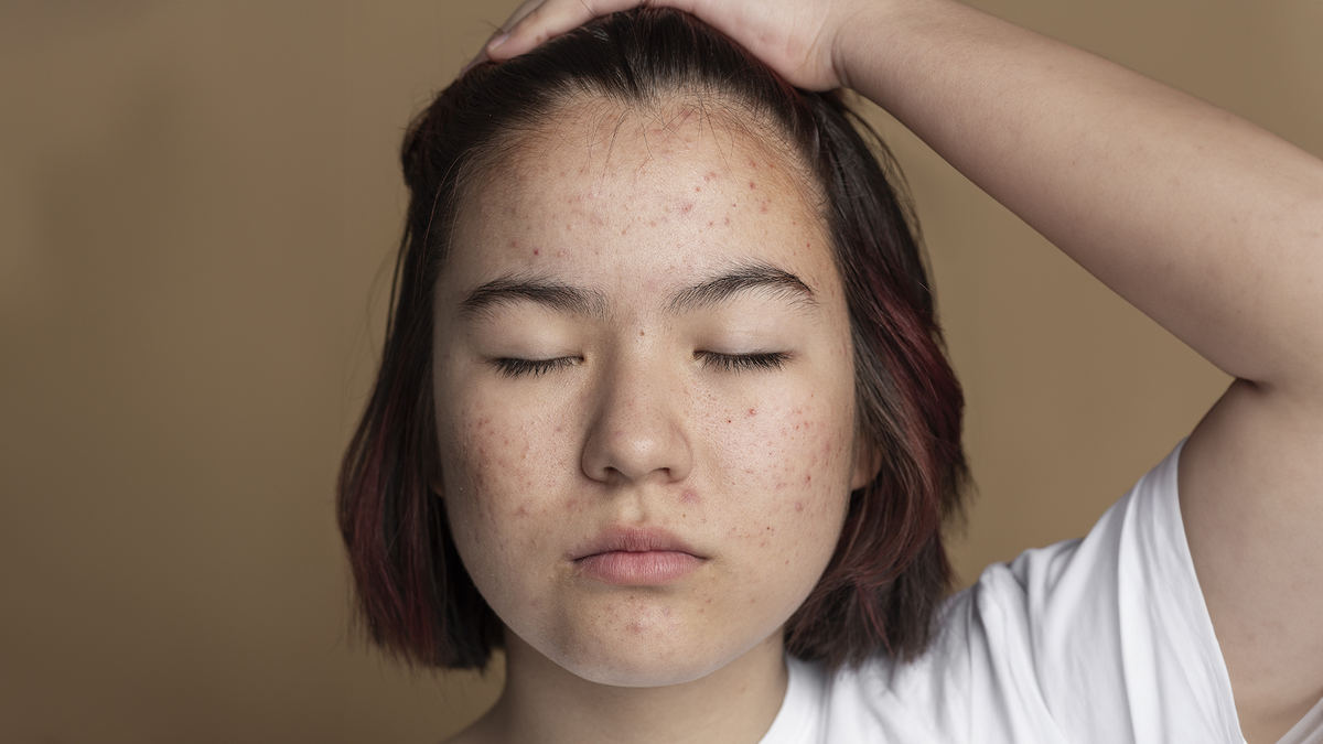 4 Skin Care Tips for Acne Awareness Month – Audaja